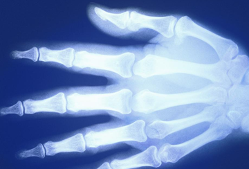 Understanding bone mineral density